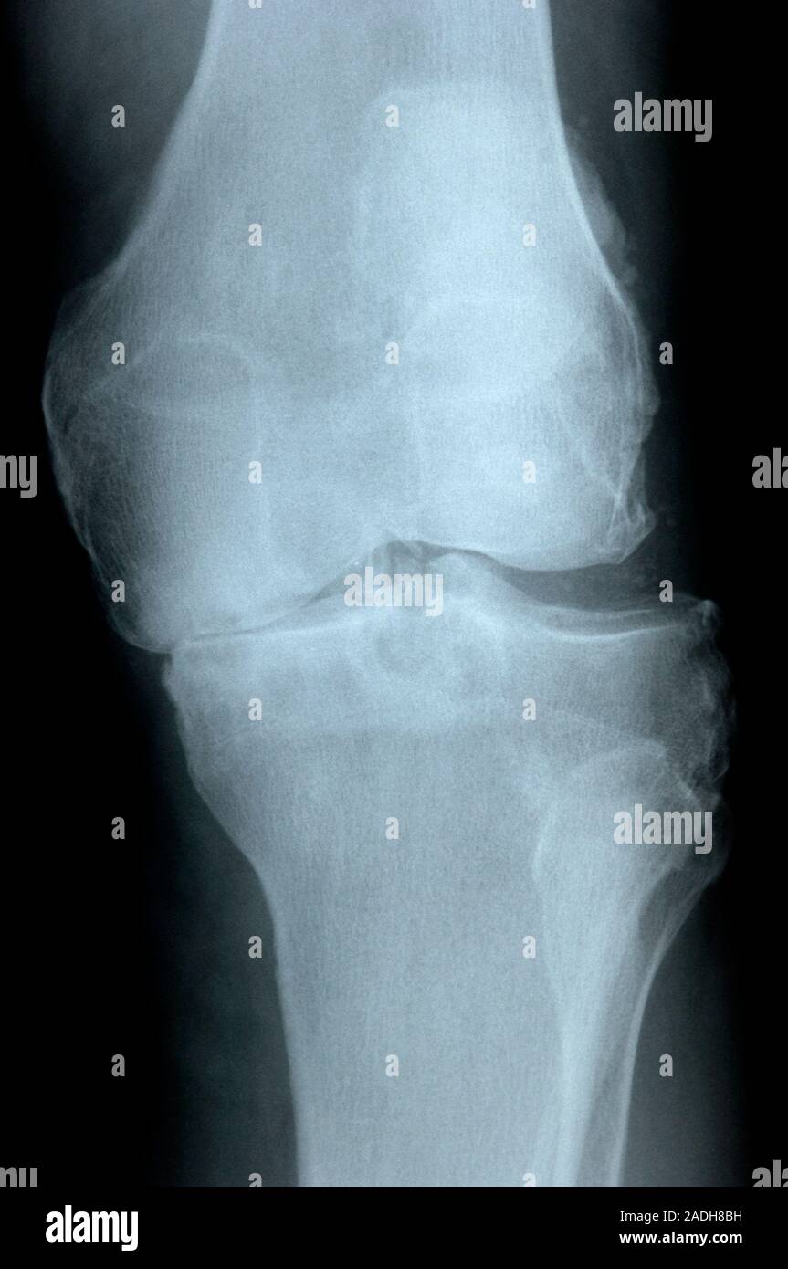 Arthrose im Knie. Vorderansicht X-ray der Knie eines 70 Jahre alten ...