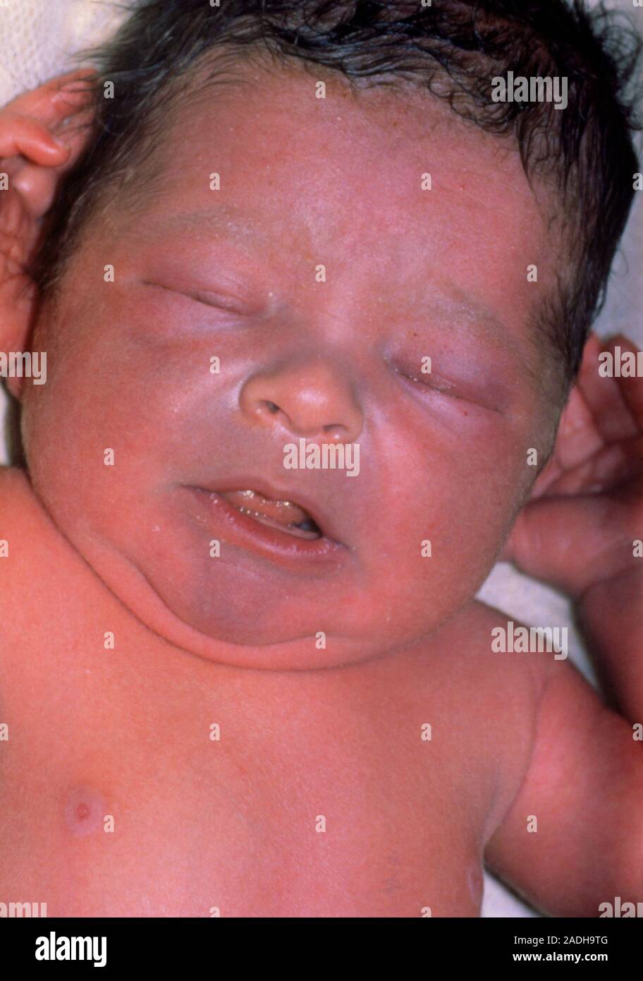 Ein blau Baby, ein Kind leiden Zyanose (lila Haut und Lippen) aufgrund ...