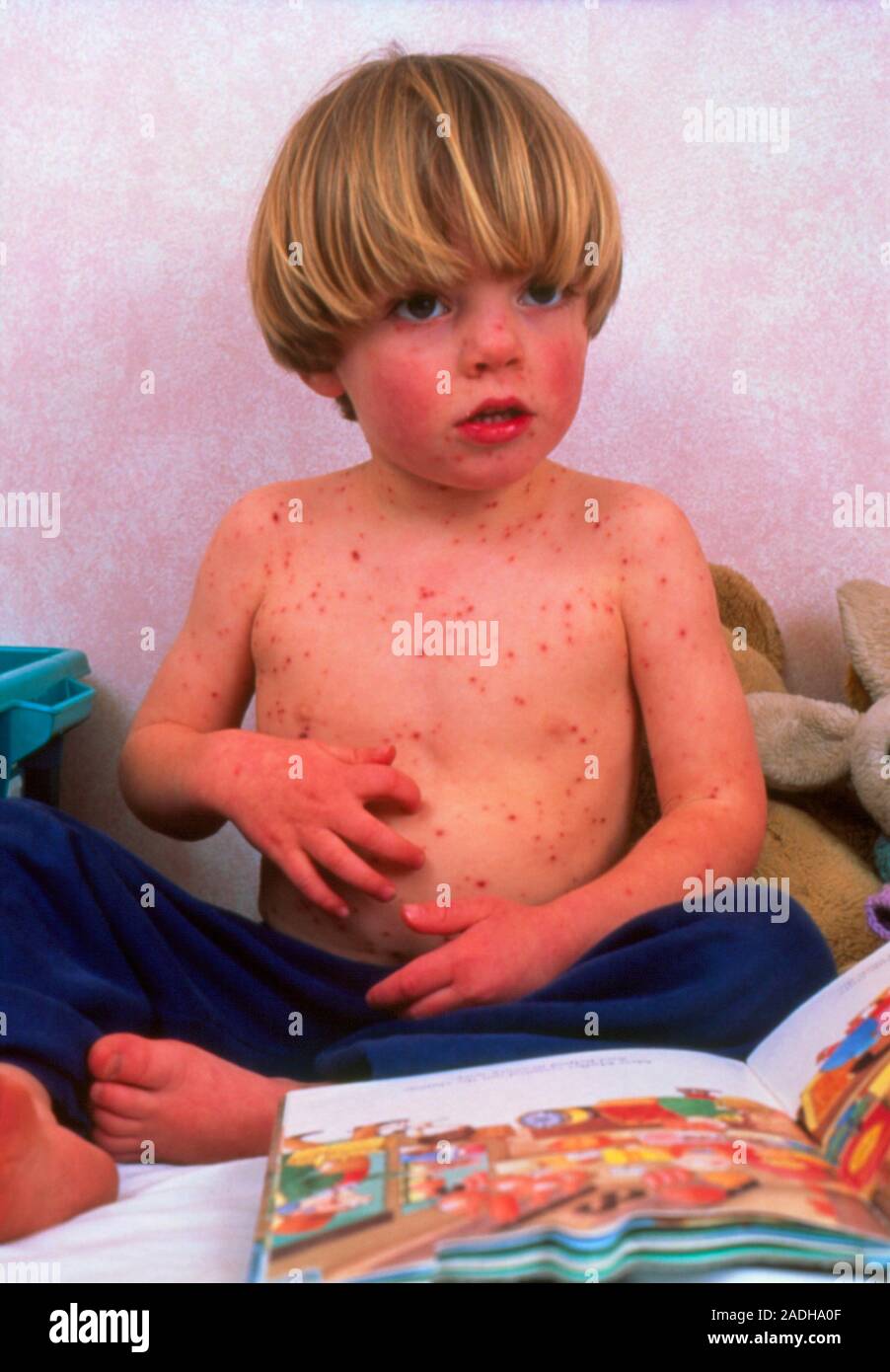 Model Released. Junge durch eine schwere Form der Varizellen betroffen ...