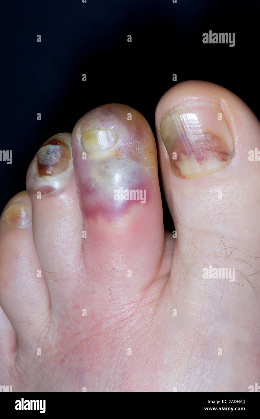 Cellulitis der Zehen einer 54 Jahre alten Frau. Cellulitis ist eine ...