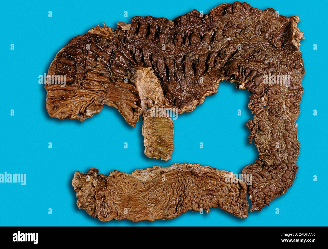 Colitis ulcerosa, grobe Muster. Colitis ulcerosa ist eine Entzündung ...