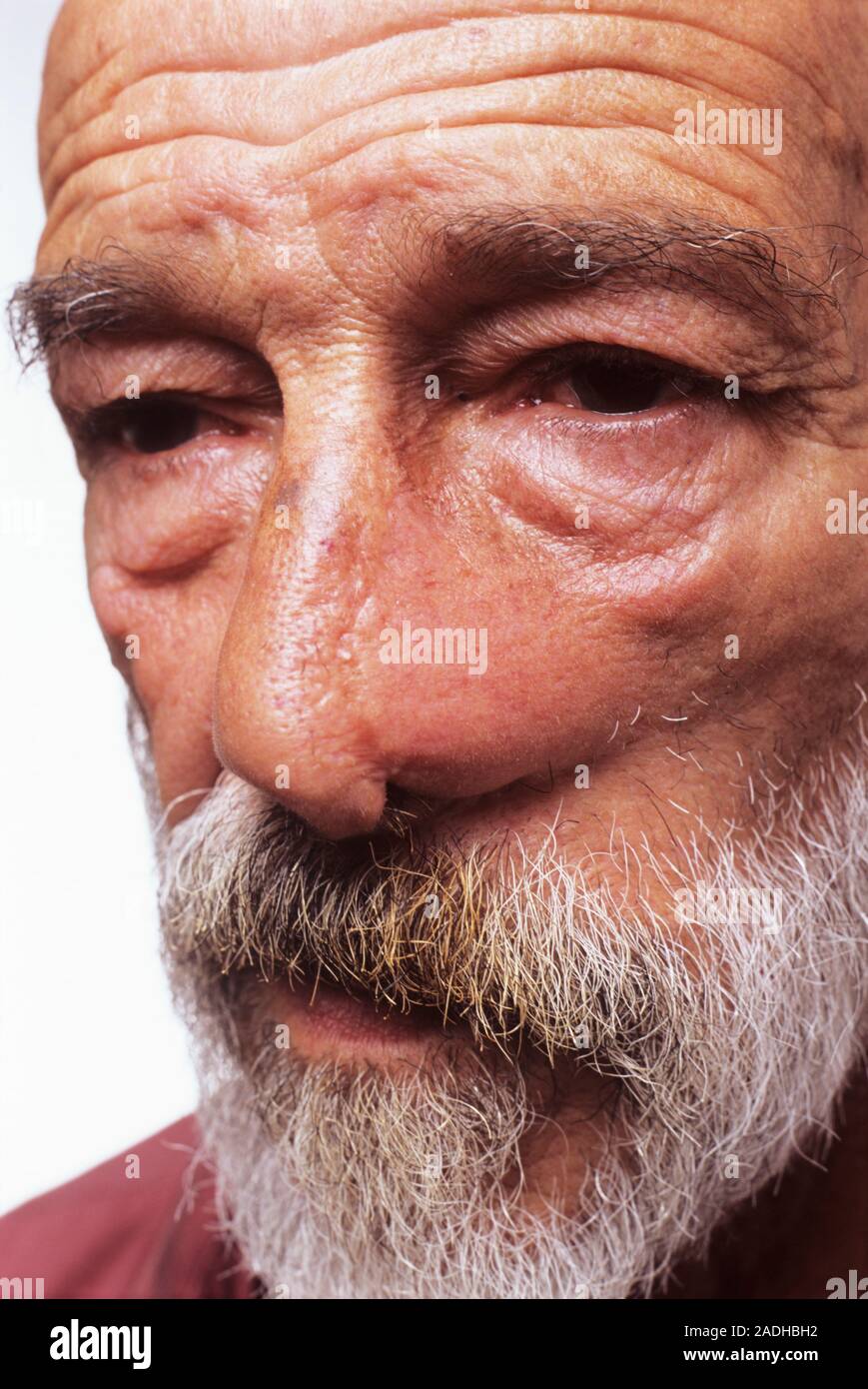 MODEL RELEASED. Hautkrebs. Gesicht eines Patienten vor chirurgischen ...