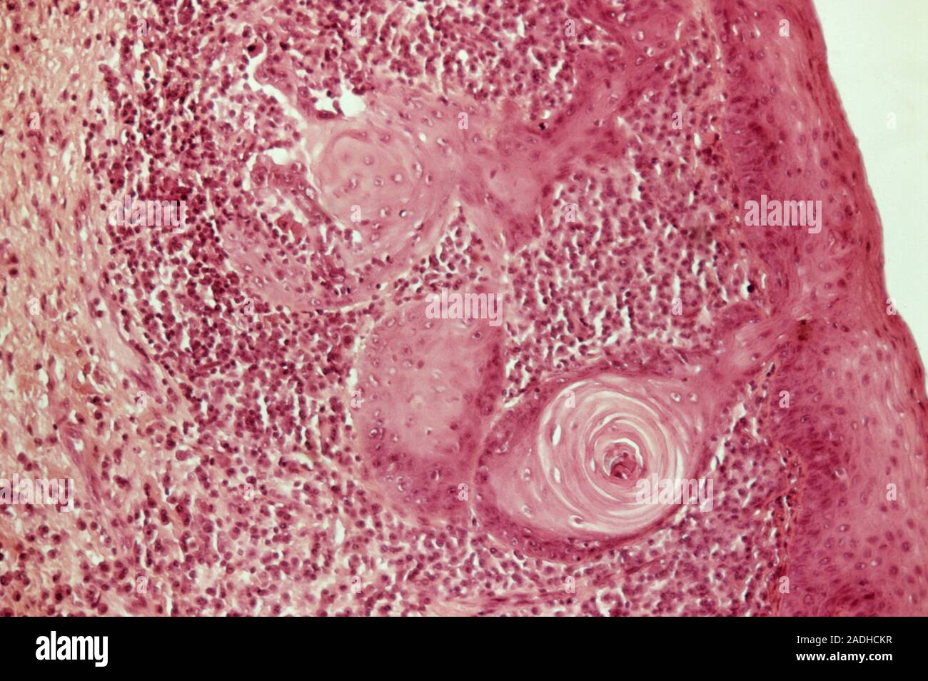 Laryngeal Krebs. Licht Aufnahme eines Abschnitts durch laryngeal Gewebe ...