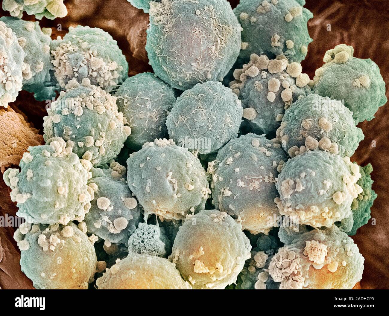 Lymphom Lymphe Zellen. Farbige Scanning Electron Micrograph (SEM) Der ...