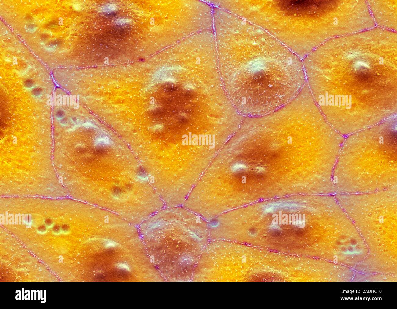 Rektale Krebszellen. Farbige Scanning Electron Micrograph (SEM) der ...
