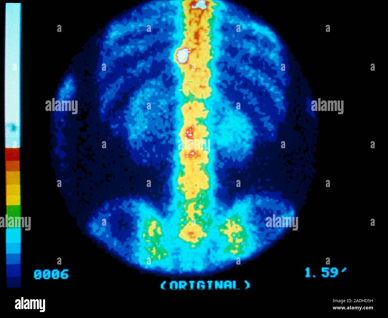 Falsche Farbe Knochen scintigram (Gamma Kamera Scan) einer ...