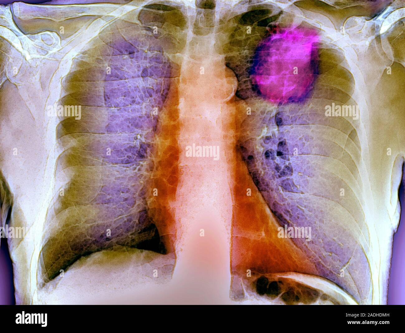 Lungenkrebs. Farbige frontal Röntgenaufnahme eines großen Tumor ...