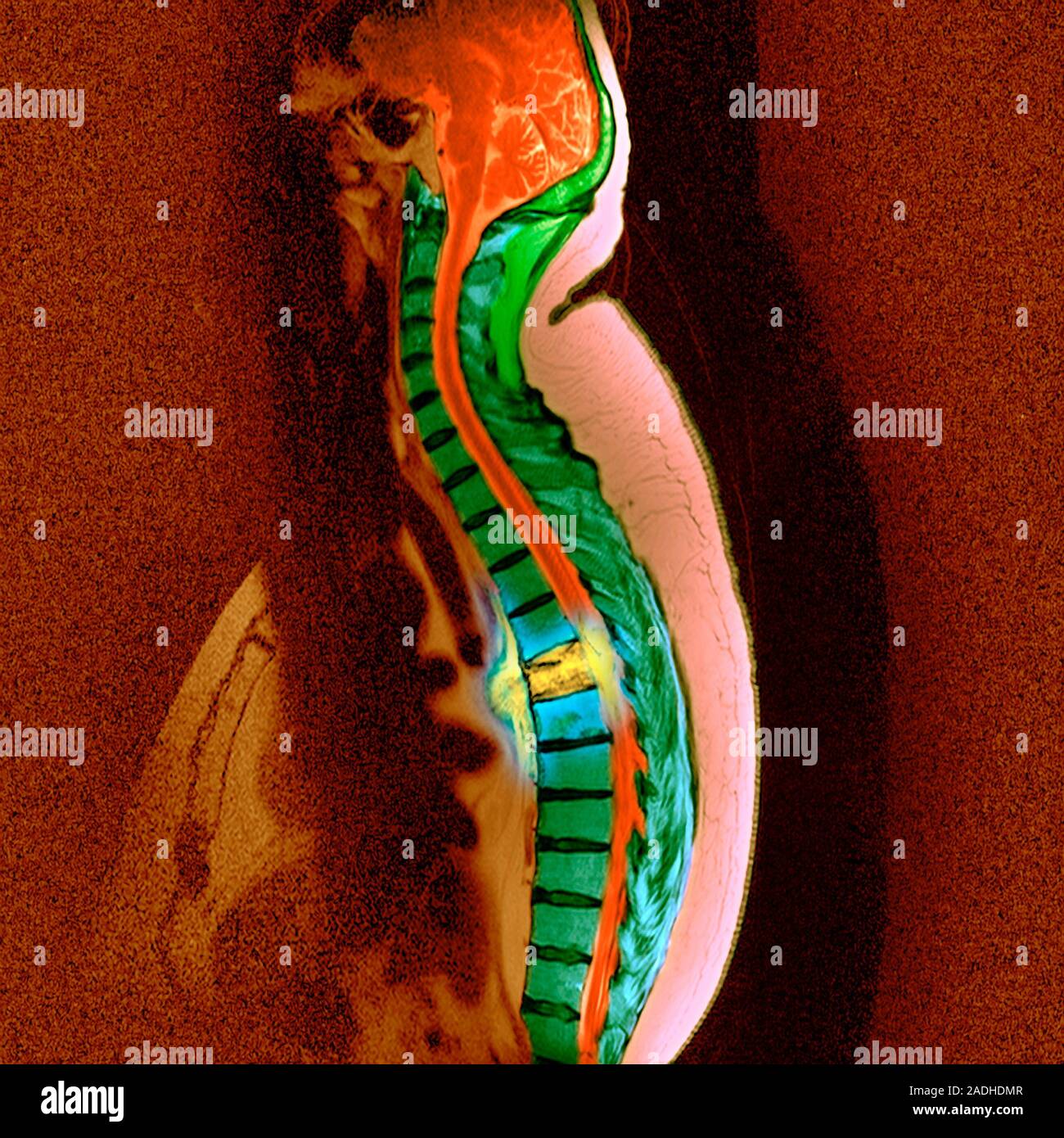 Knochenkrebs. Farbige sagittal (Seite) Magnetresonanztomographie (MRT ...