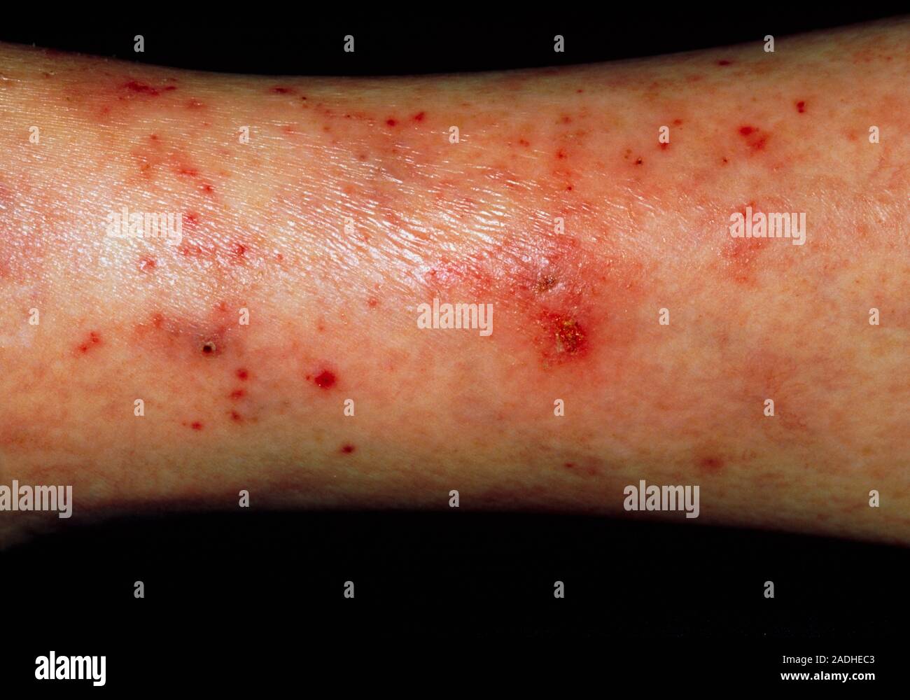 Dermatitis artifacta. Nahaufnahme einer Hautausschlag durch artifacta ...