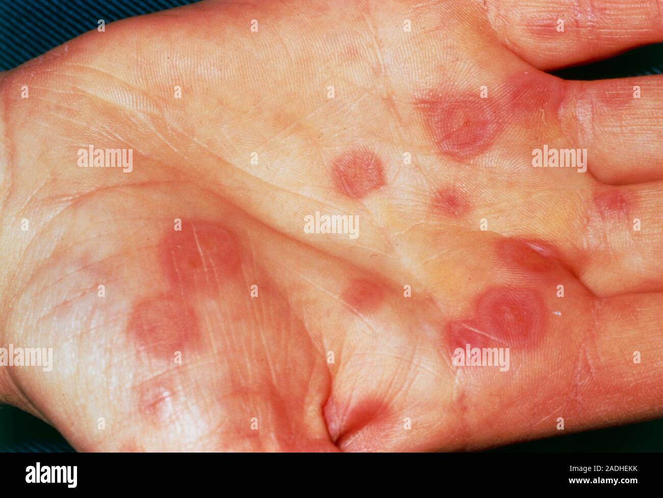 Erythema multiforme Ausschlag auf der Hand eines Patienten. Diese ...