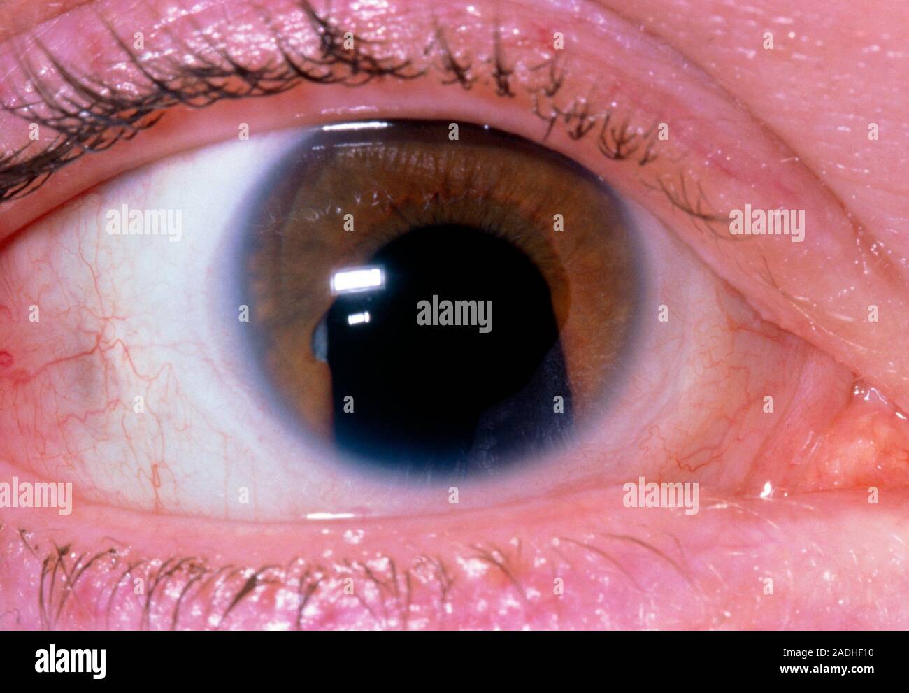 Coloboma. In der Nähe von Auge zeigt eine vergrößerte Pupille, die zu ...