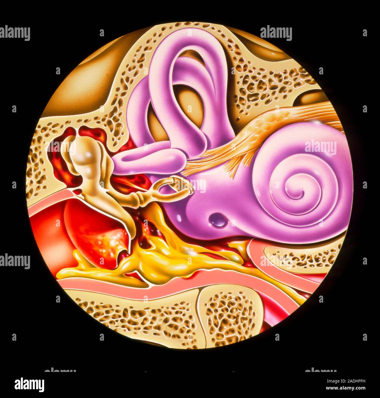 Otitis media. Zeigt den Bereich des Mittelohrs von Otitis media ... Otitis media. Zeigt den Bereich des Mittelohrs von Otitis media ...