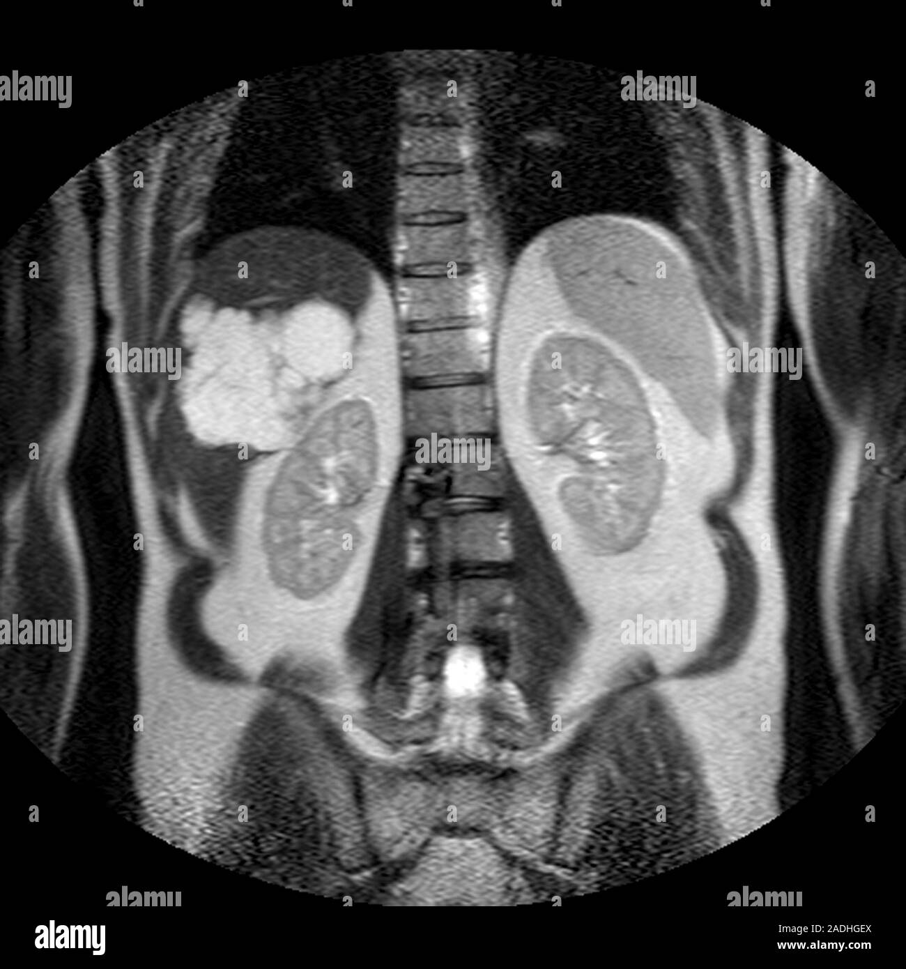 Leber Blutgefäß Tumor. Die Magnetresonanztomographie (MRT) Scan zeigt ...