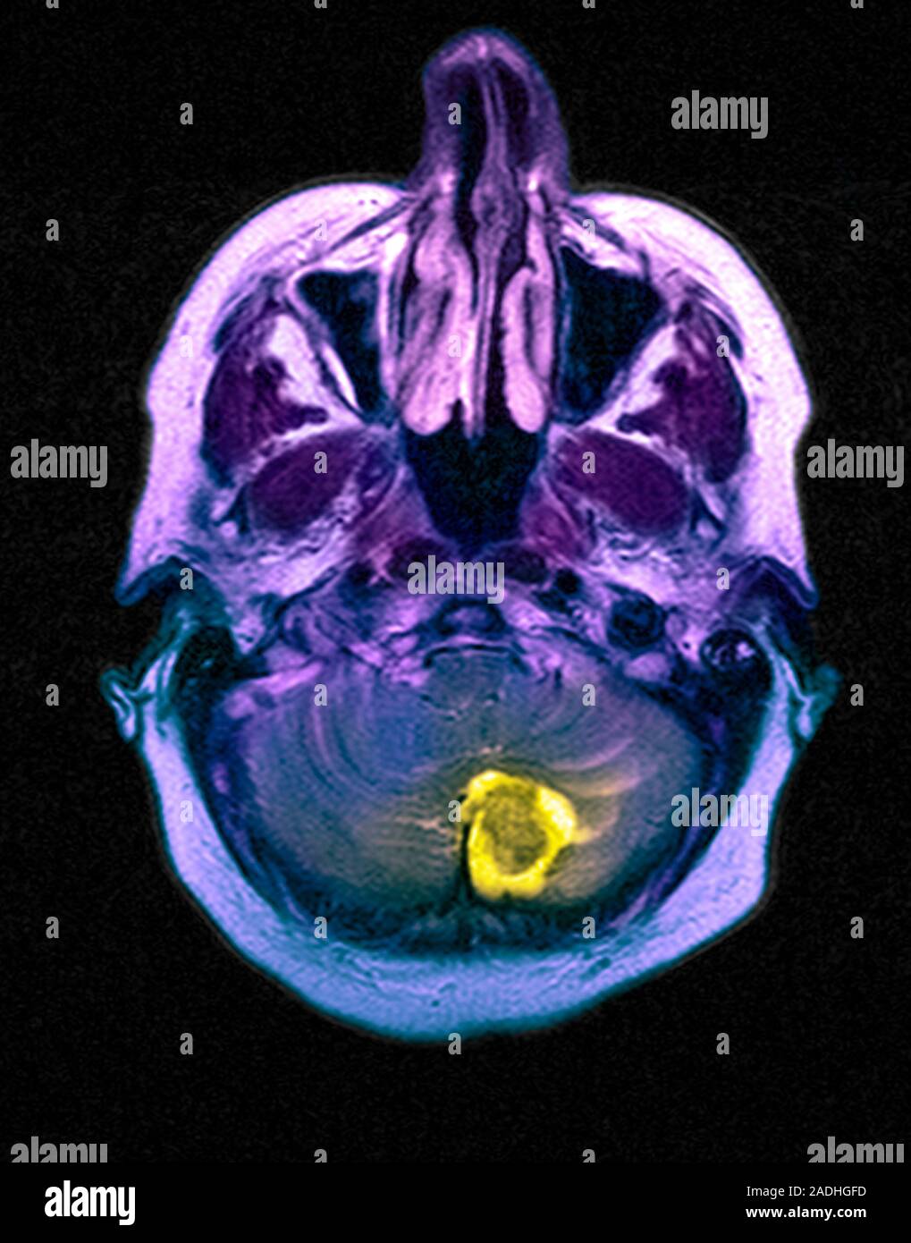 Haemangioblastoma Gehirntumor. Farbige Magnetresonanztomographie (MRT) Scan eines axialen ...