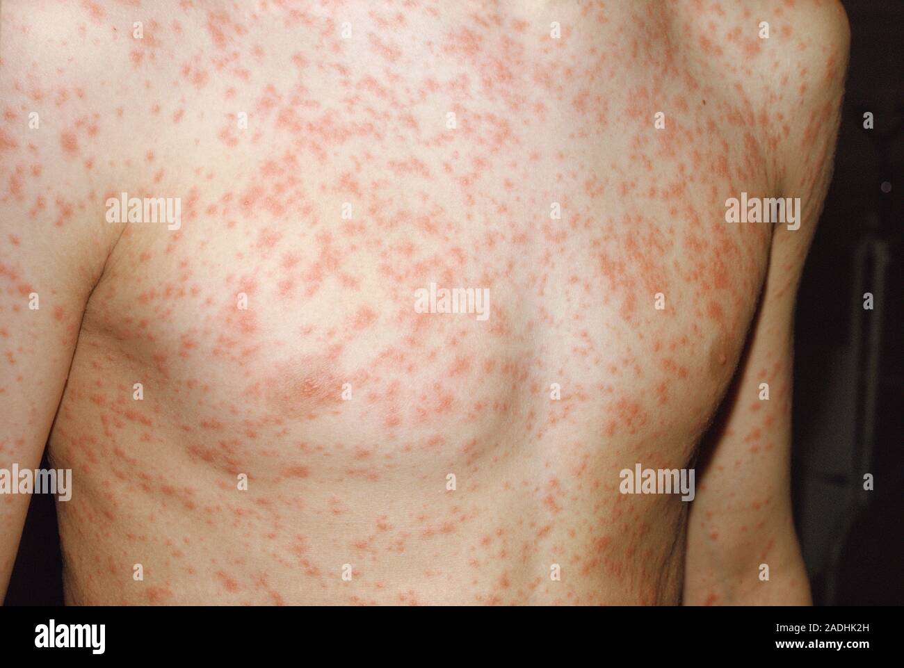Röteln Ausschlag auf der Brust ein Junge. Röteln oder Masern, die ...