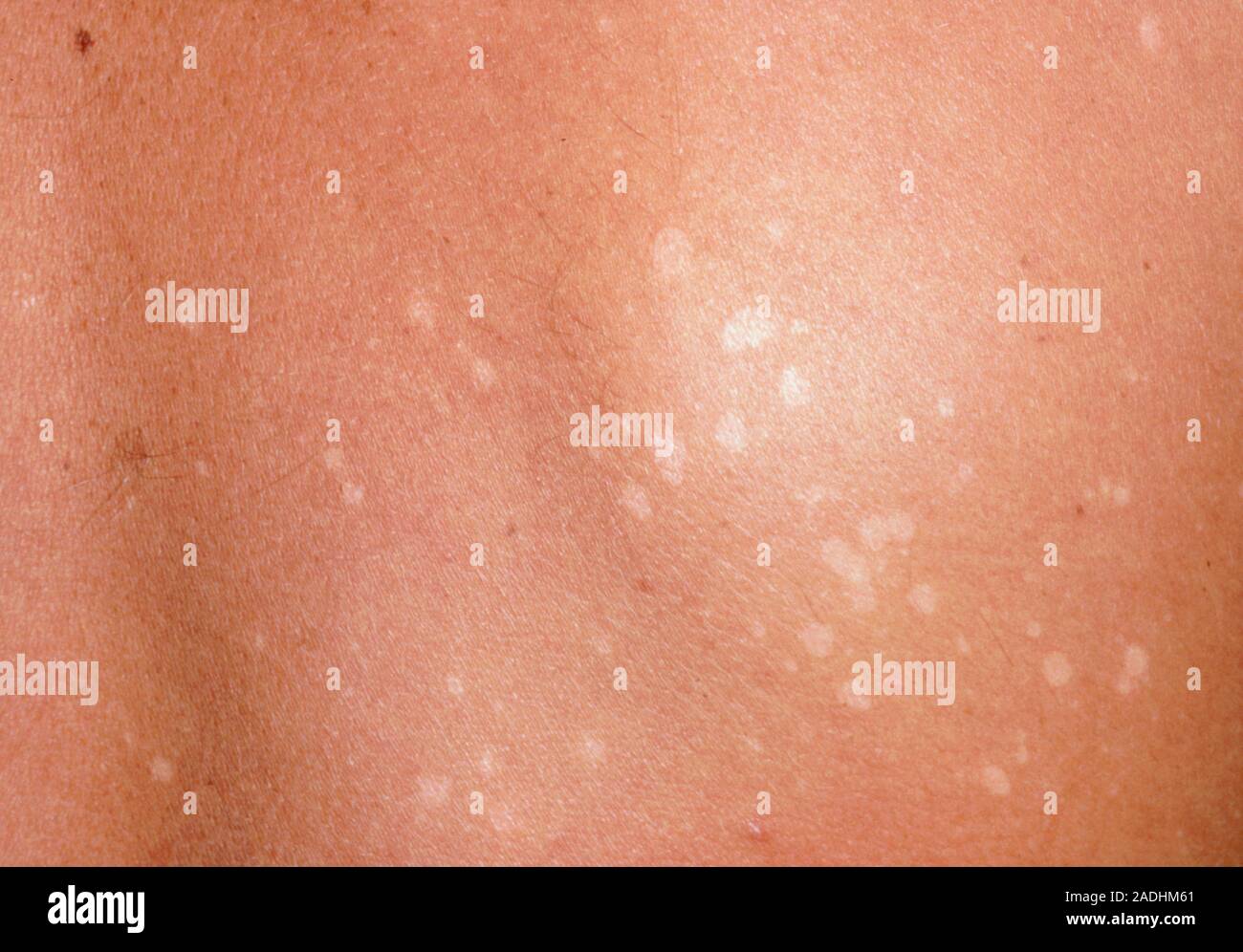 Pityriasis versicolor (Tinea versicolor), eine Pilzinfektion ...