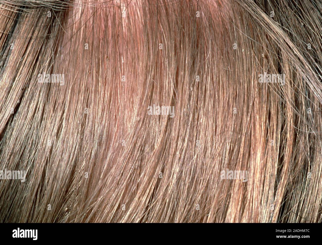 Nits (pediculosis). Nits (kopflaus Eier) in Hu-man Haar. Die Nissen ...