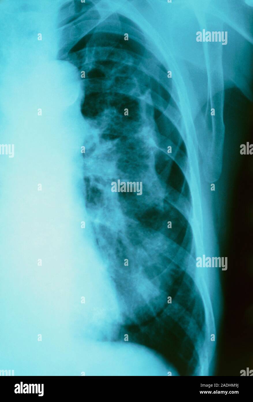 Pneumothorax und Emphysem. Farbige Chest X-Ray von eine 65 Jahre alte ...