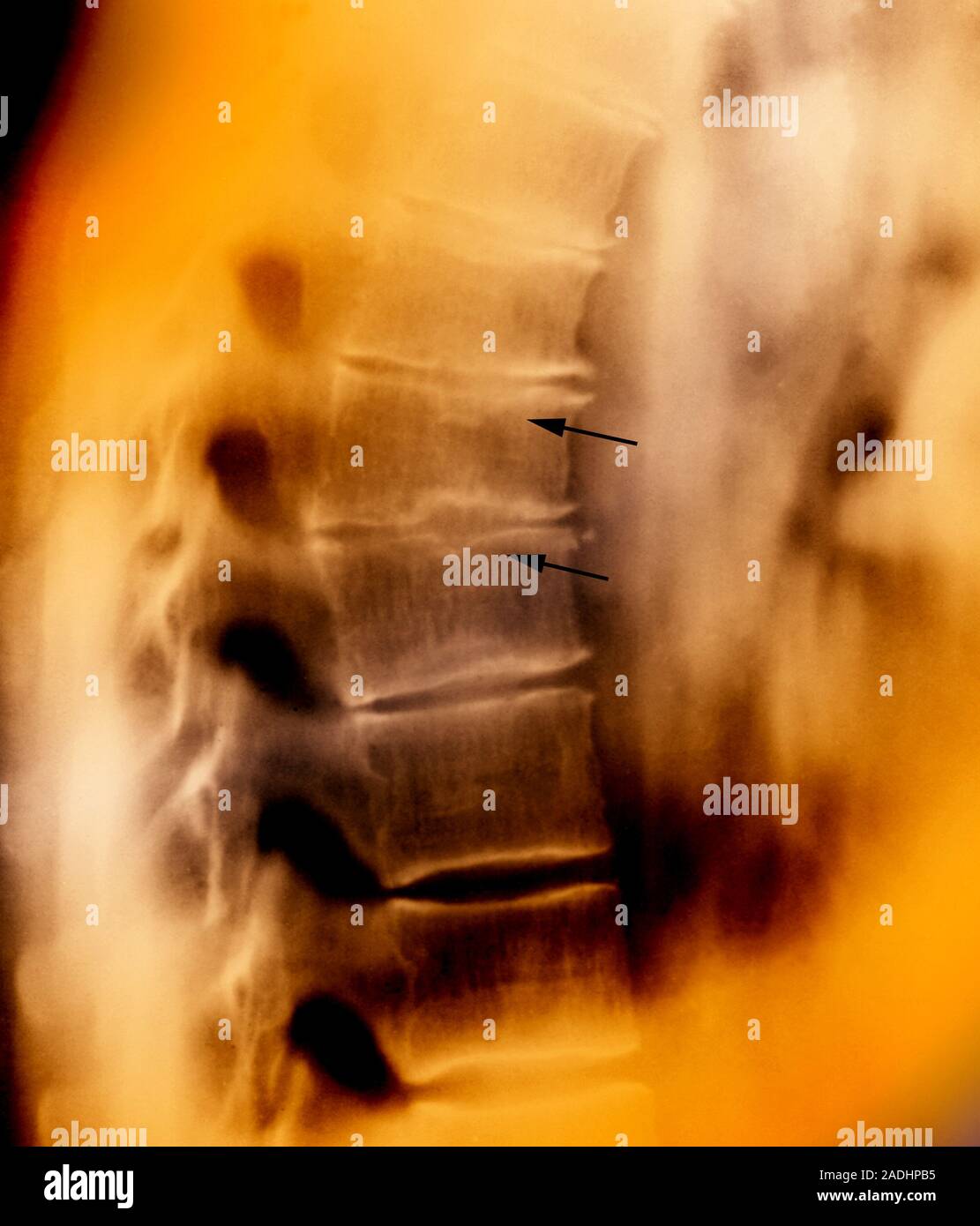 Scheuermann Krankheit. Farbige CT (Computertomographie) Scan der ...