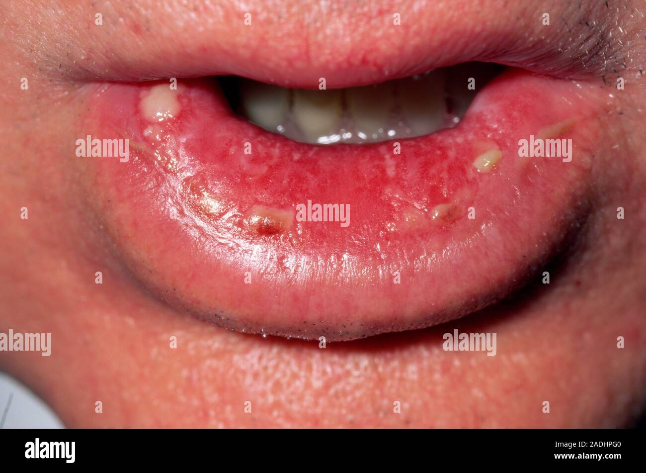 Herpetic Stomatitis. Fieberbläschen an der Lippe eines 60 Jahre alten ...