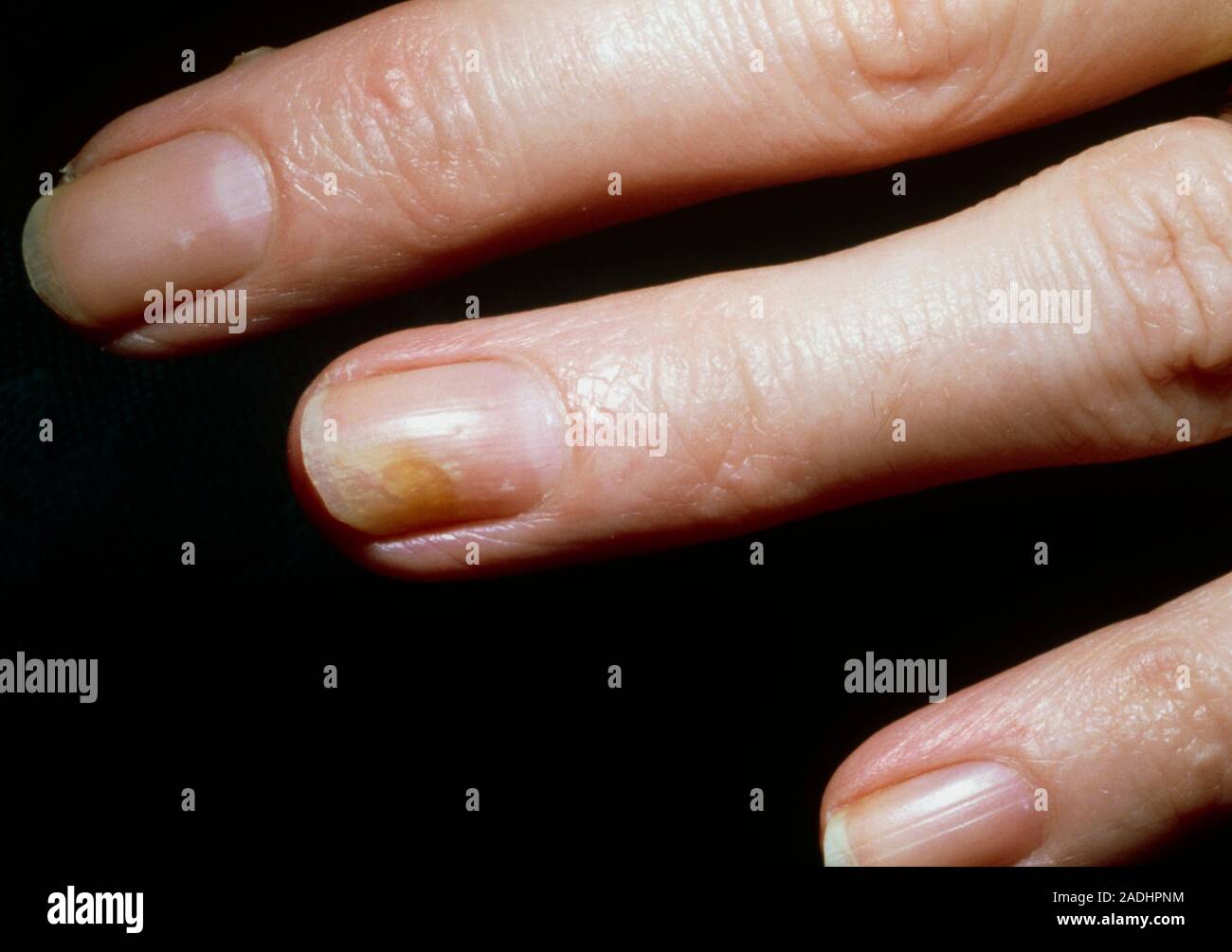 Tinea pilzartige Infektion. Chronische ringworm von einer Frau ...