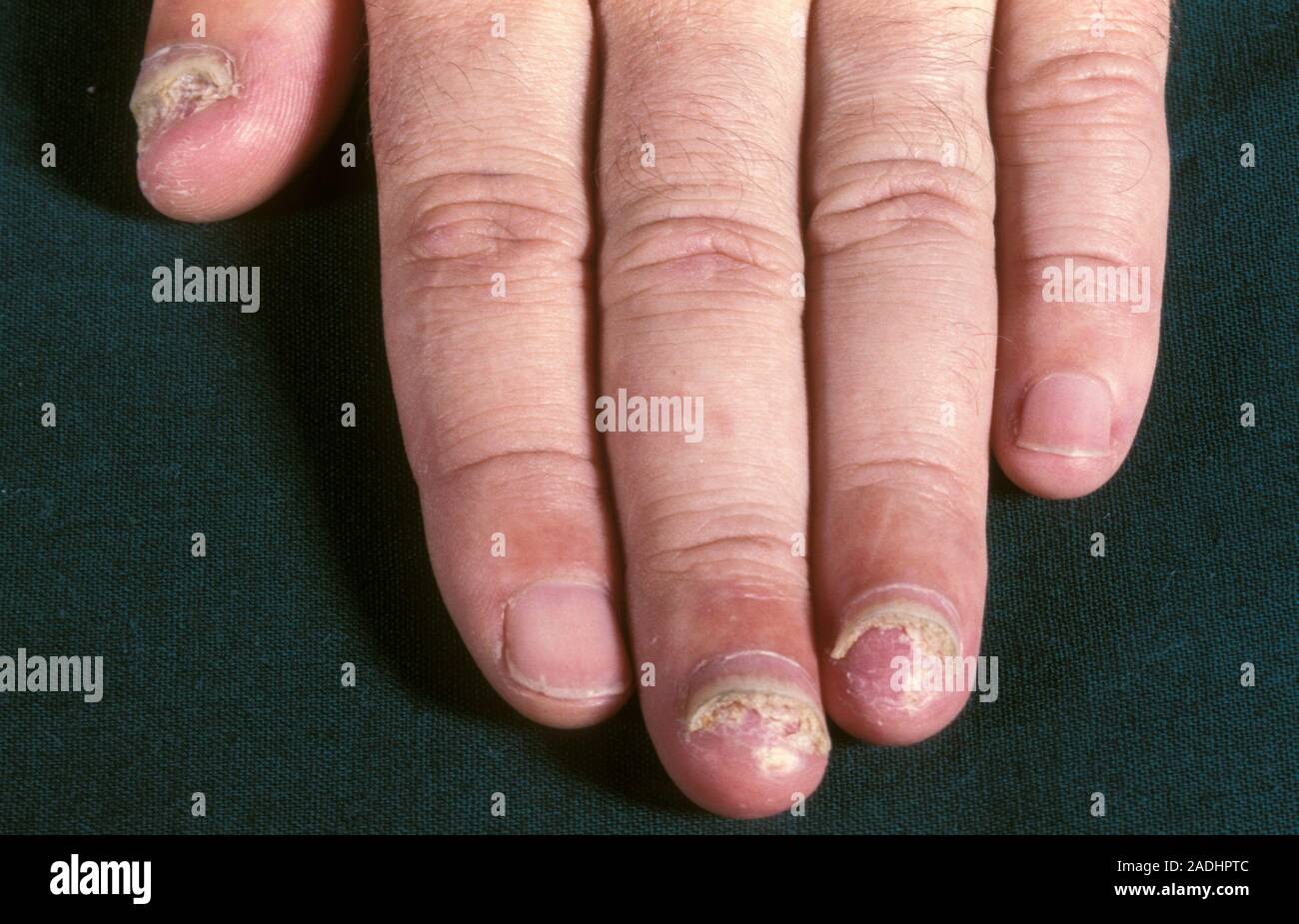 Pilzinfektion am Finger Nägel eines Patienten. Dies ist tinea unguium ...