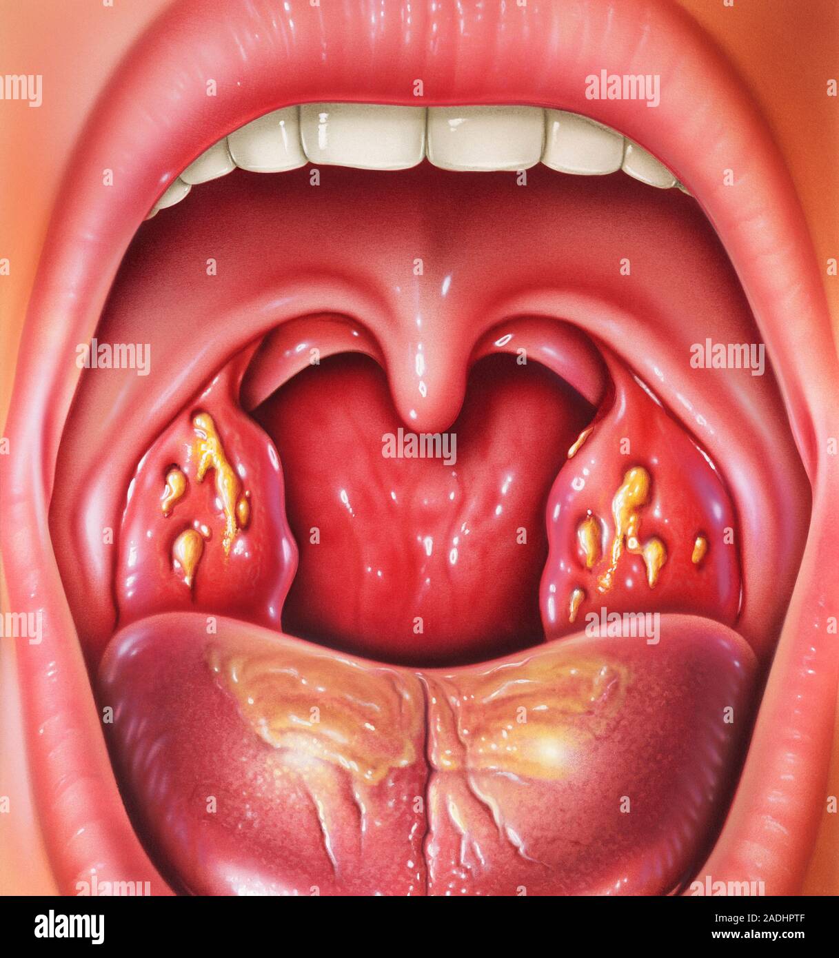 Mandelentz ndung Artwork Der Offenen Mund Und Rachen Eines Patienten Mandelentz ndung Artwork Der Offenen Mund Und Rachen Eines Patienten