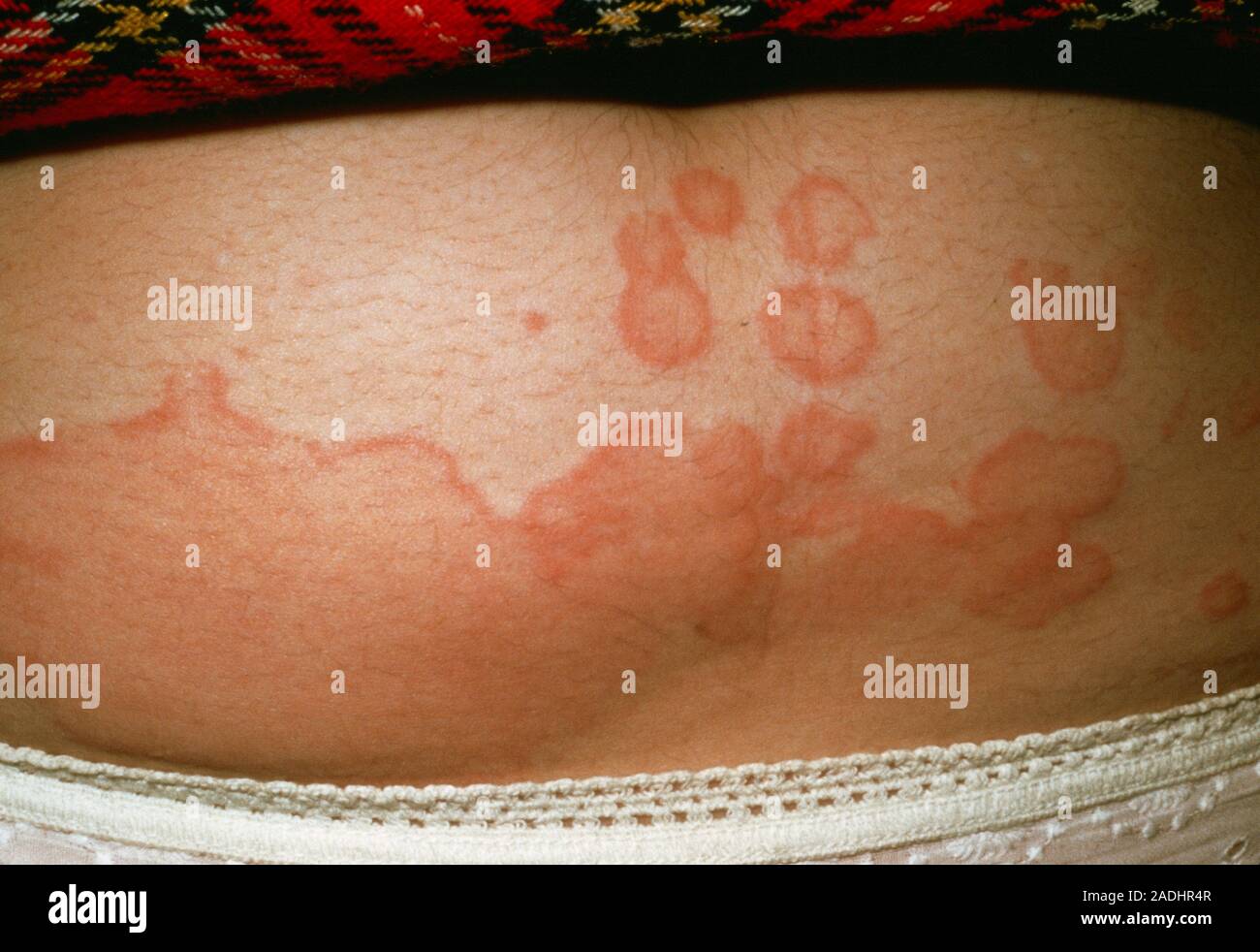 Urtikaria Ausschlag am Körper des Patienten. Auch als Nesselsucht oder ...