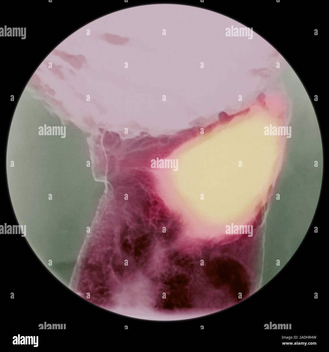 Magengeschwür. Farbige barium X-ray von einem Magengeschwür (Gelb) im ...