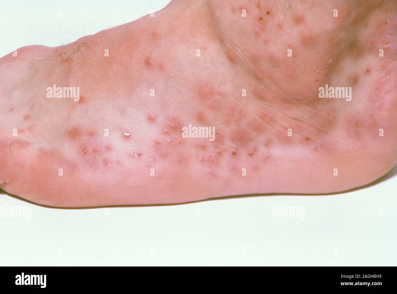 Hautausschlag von Bettwanzen auf Patienten zu Fuß. Cimex lectularius ...