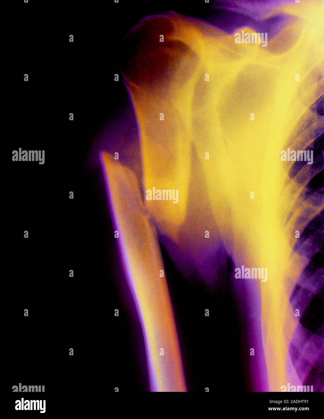 Obere armbone gebrochen. Farbige X-ray Bild mit einer schweren compound ...
