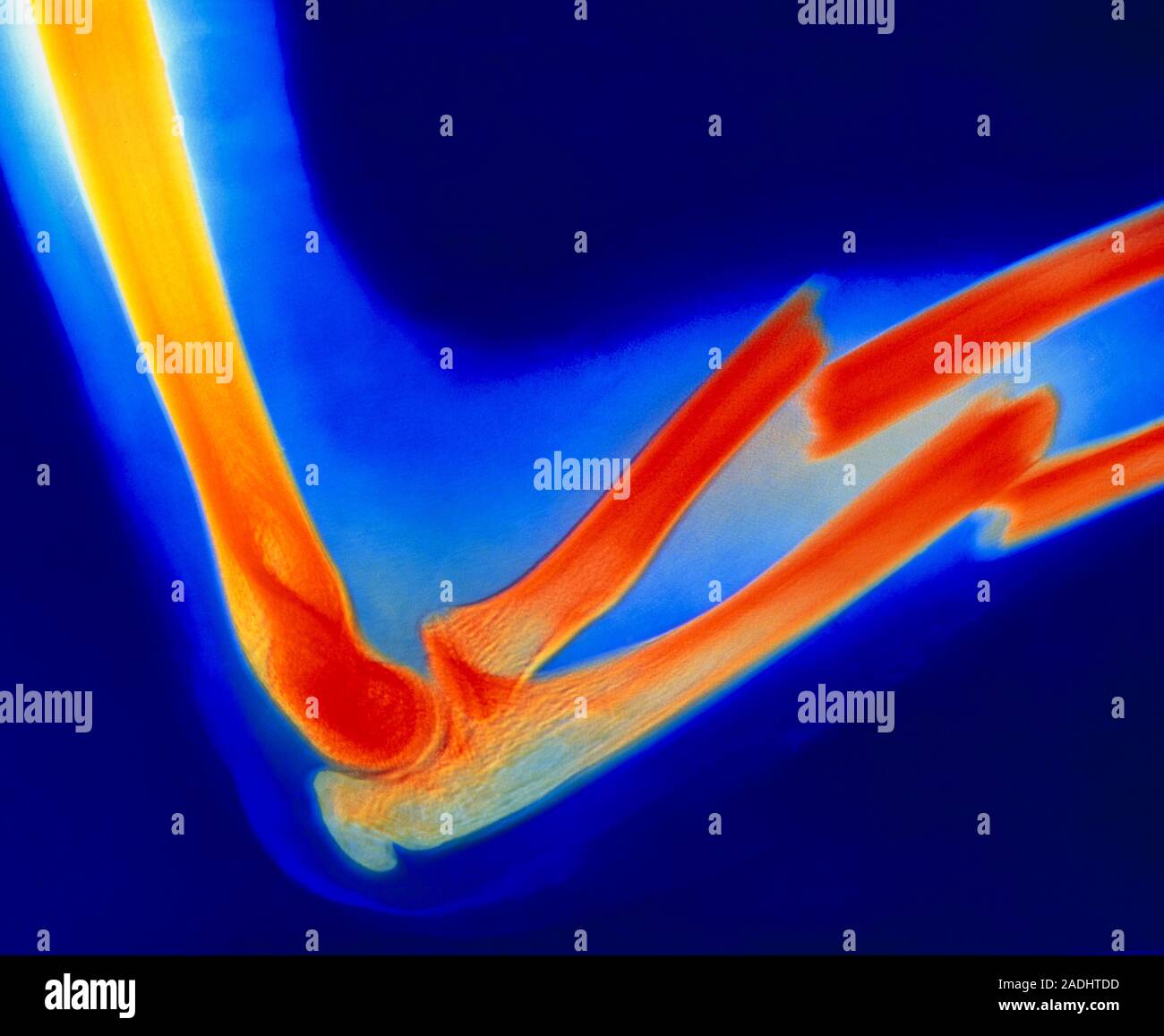 Arm gebrochen. Farbige X-ray eines zusammengesetzten Bruch zu den ...