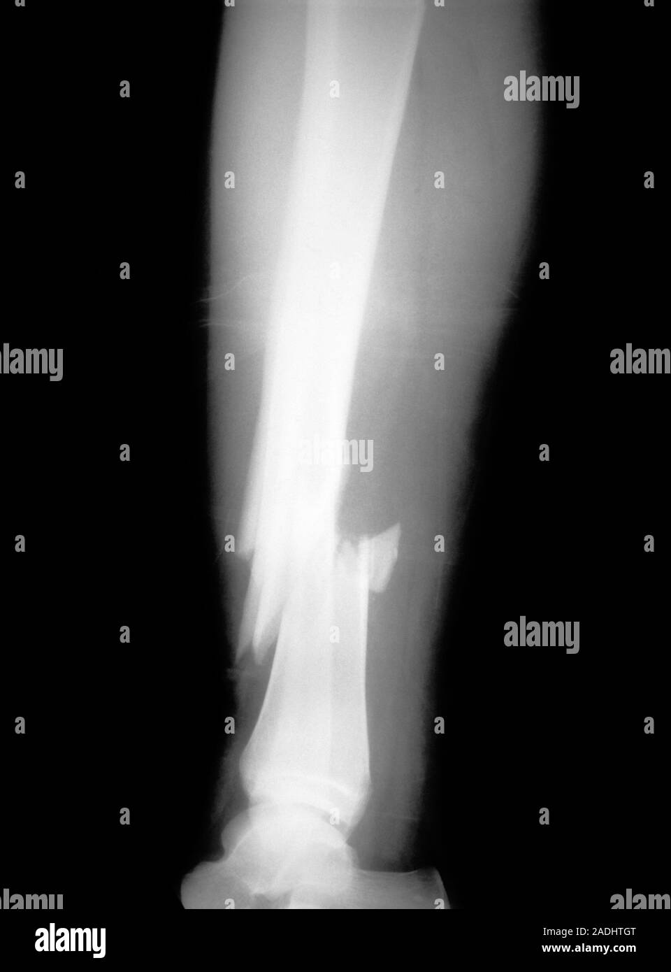 Bein gebrochen. X-ray von einem gebrochenen Bein. Die Knochen der ...