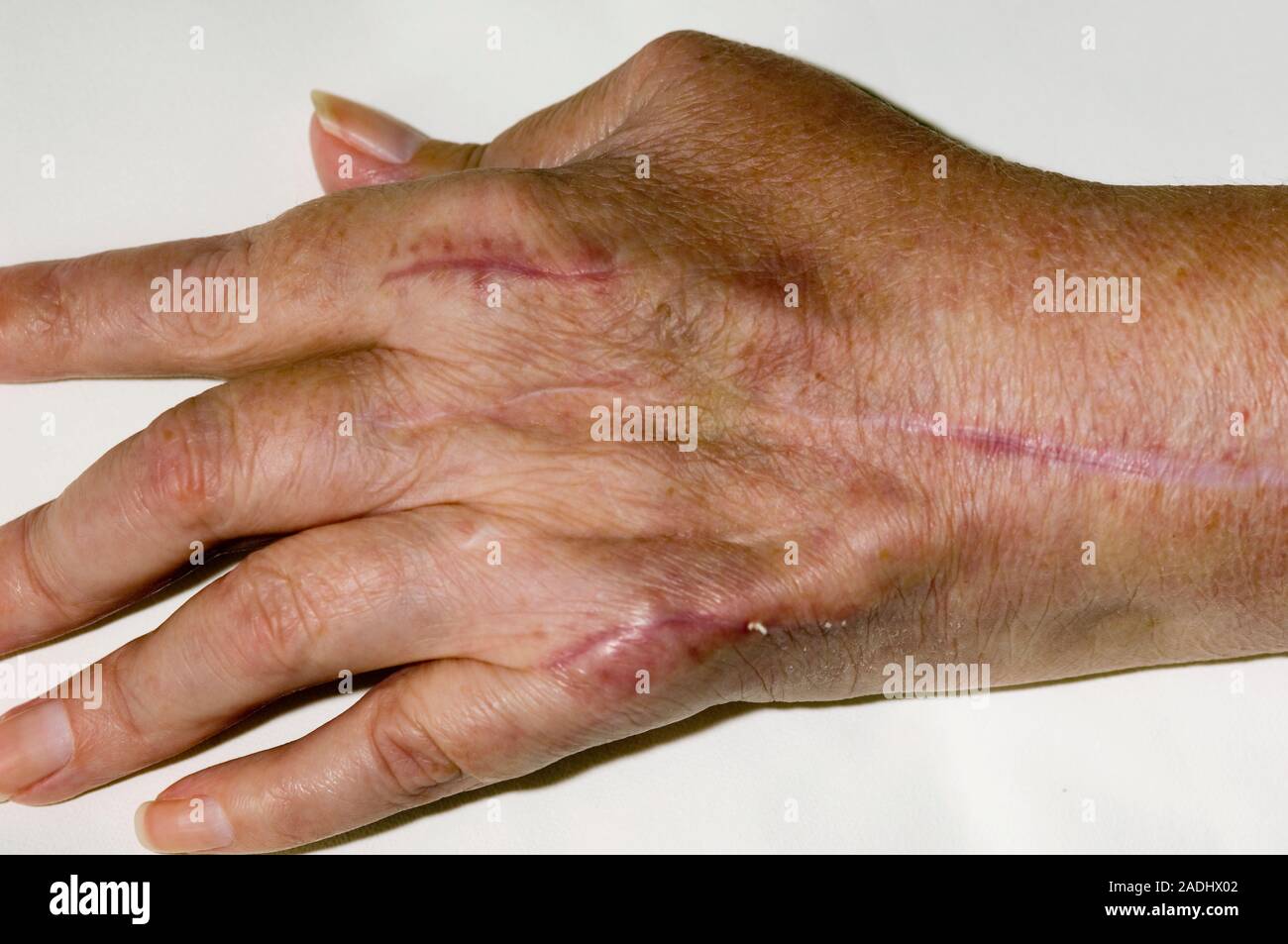 MODEL RELEASED. Op-Narben auf der Hand eine 56jaehrige Frau Tendon ...