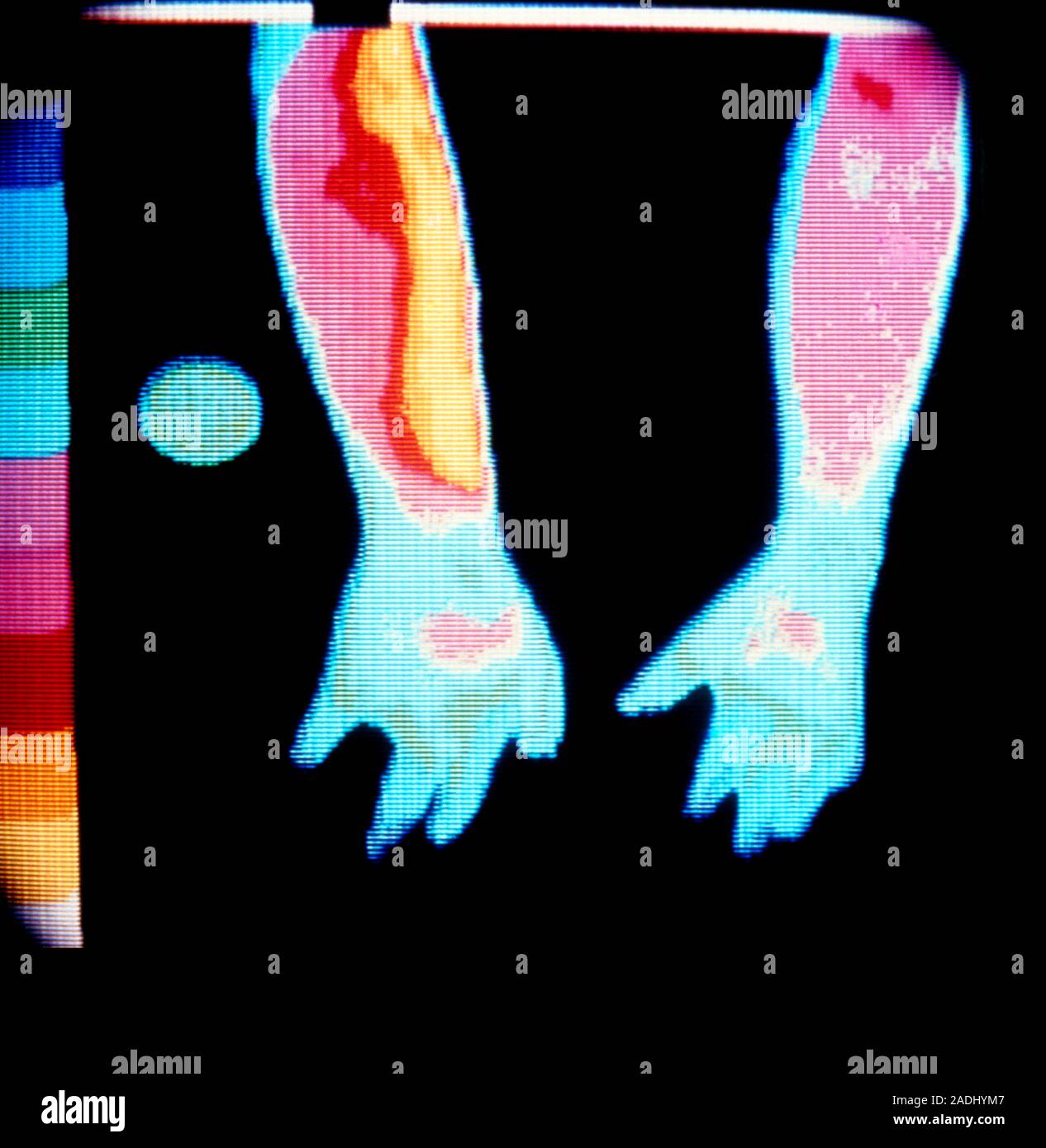 Thermogramm der Arme und Hände einer Person nach dem Rauchen einer ...