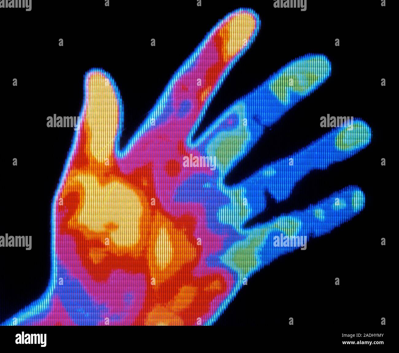 Thermogramm der Hand eines Rauchers, zeigt die Temperaturverteilung im ...