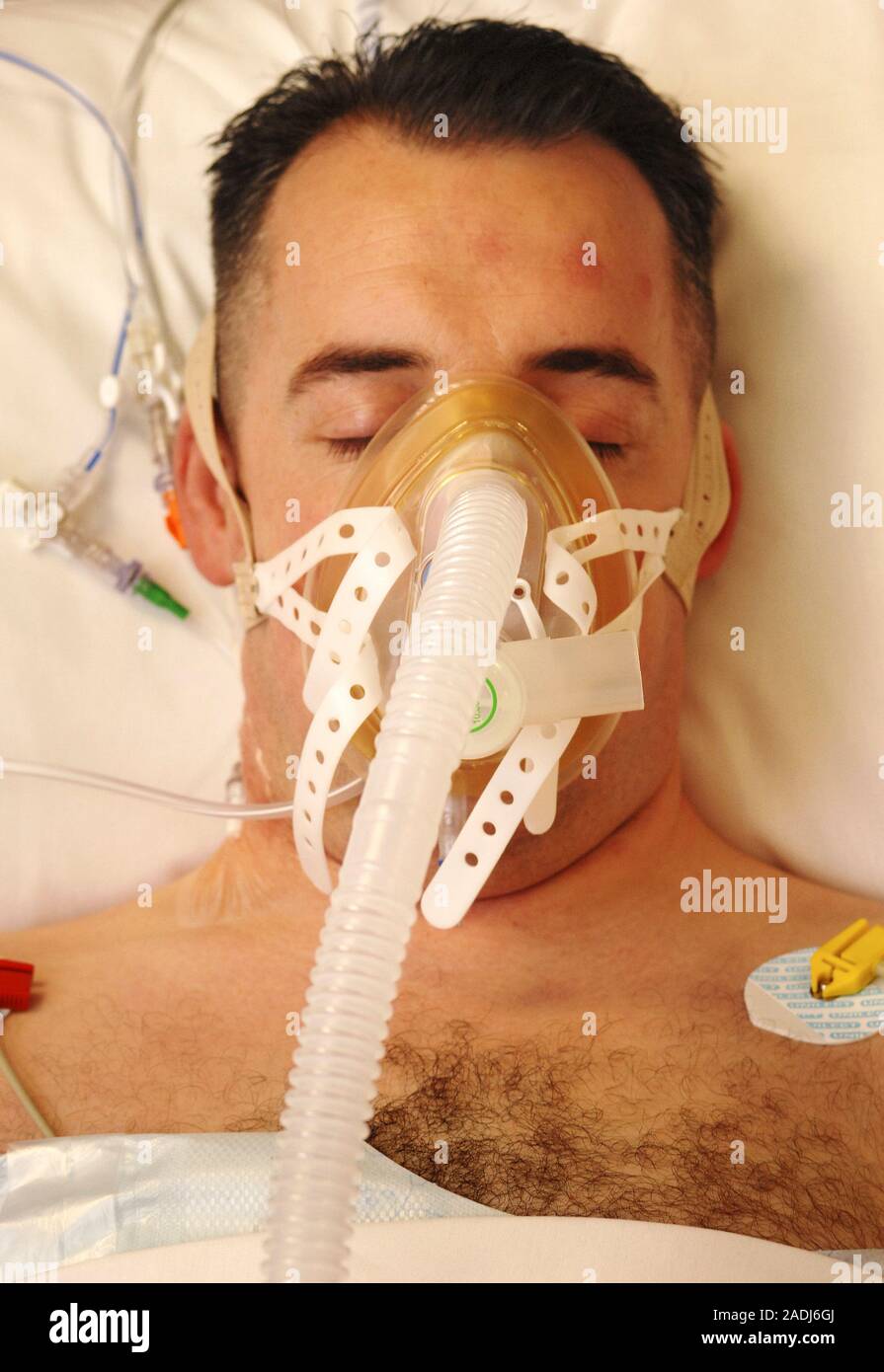 MODEL RELEASED. Intensive Care Patient. Gesicht eines männlichen ...