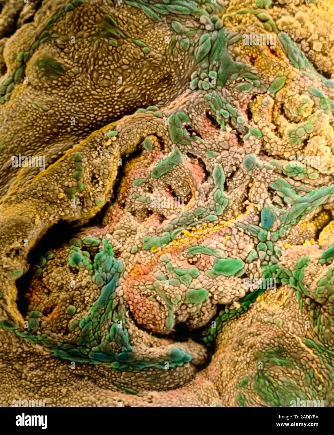 Uteriner Adenokarzinome. Farbige Scanning Electron Micrograph (SEM) der ...