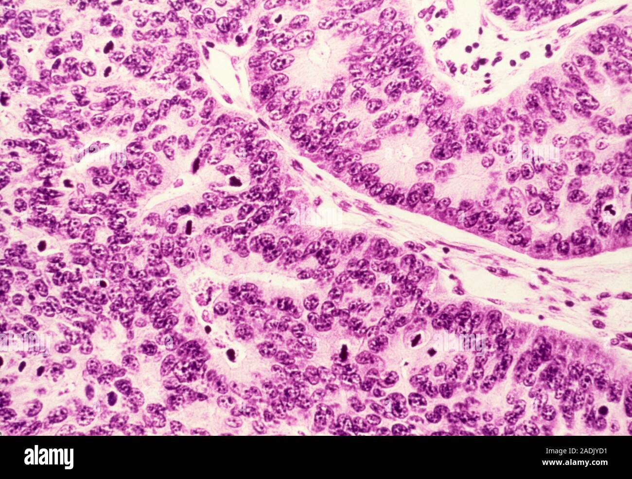 Uteriner Adenokarzinome. Leichte Aufnahme von Adenokarzinom des ...