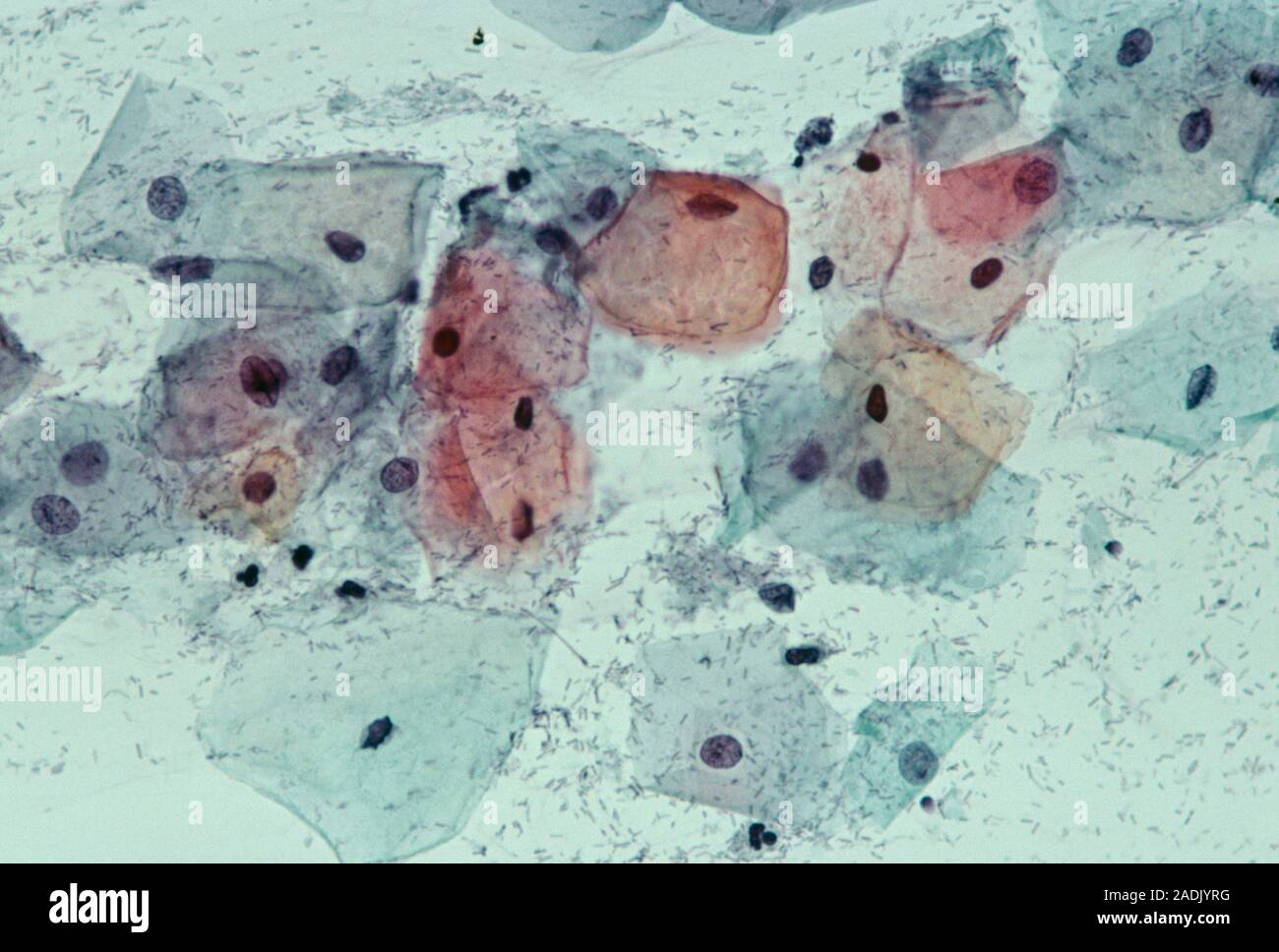 Abstrich. Leichte Aufnahme von einen Abstrich mit normalen squamous ...