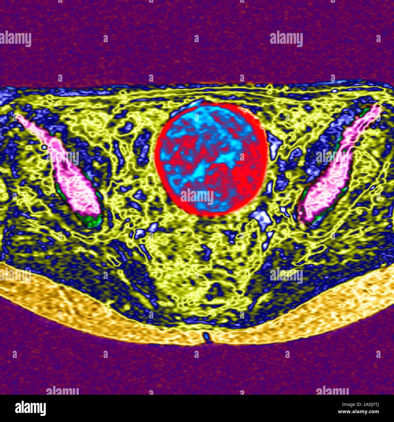 Gebärmutter myom. Farbige Magnetresonanztomographie (MRT) Scan eines ...