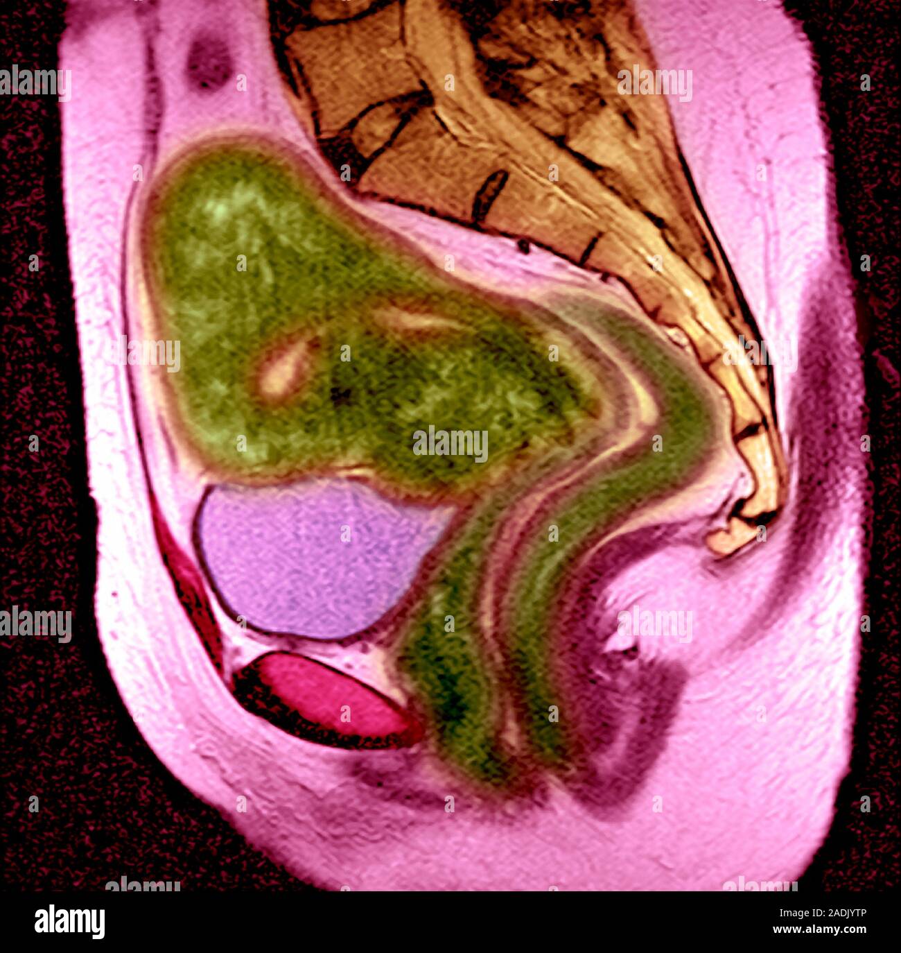 Gebärmutter myom. Farbige Magnetresonanztomographie (MRT) Scan eines ...