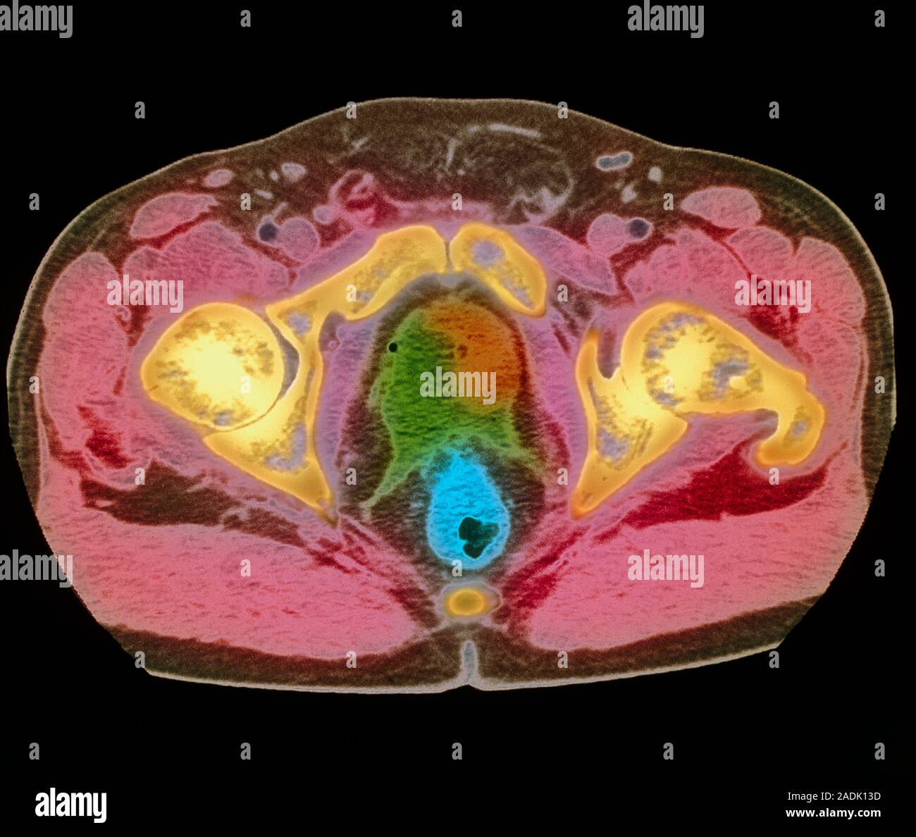 Prostatakrebs. Farbige Magnetresonanztomographie (MRT) Scan eines ...