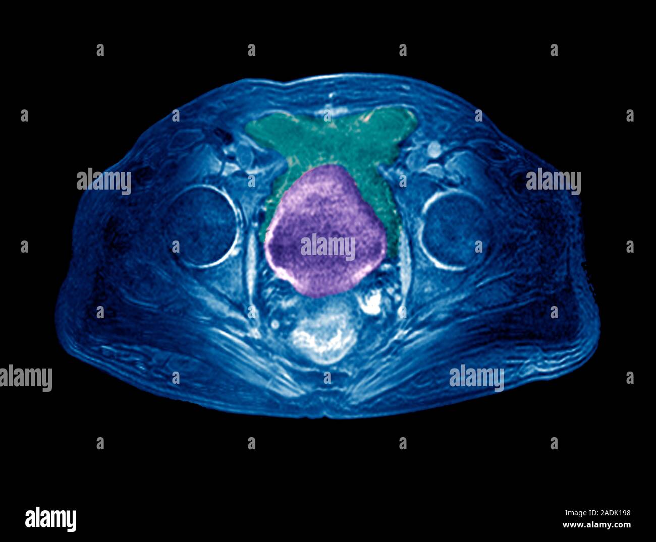 Prostatakrebs. Farbige Magnetresonanztomographie (MRT) Scan eines ...