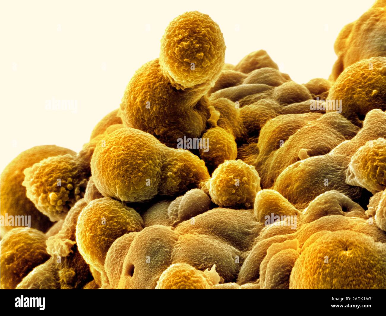 Prostatakrebszellen, Farbig Scanning Electron Micrograph (SEM). Die ...