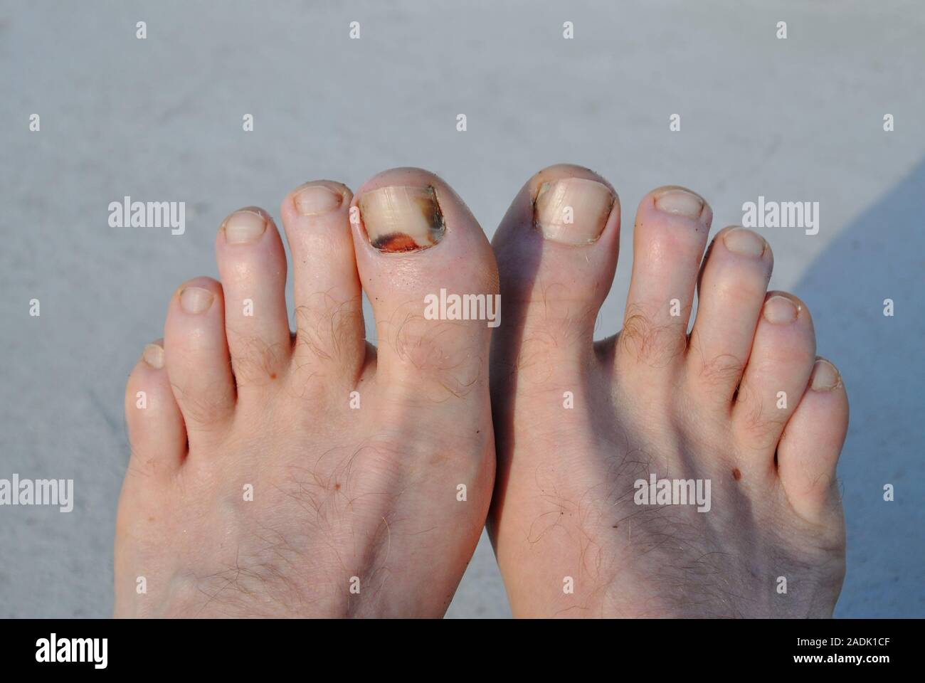 Verletzte Zehe Stockfotos und -bilder Kaufen - Alamy