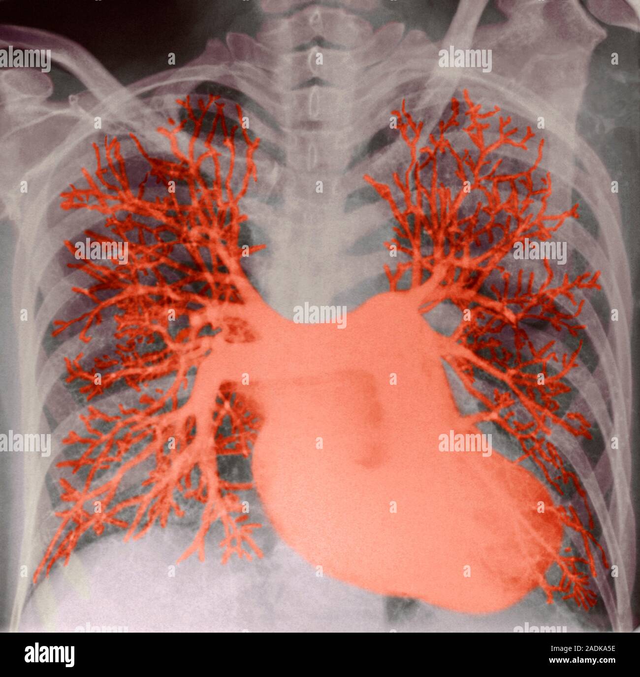 Die Blutgefäße der Lunge. Farbige angiogram des Herzens und der ...