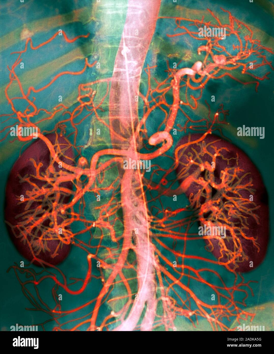 Abdominale Arterien. Farbige angiogramm der Arterien des Abdomens. Die ...