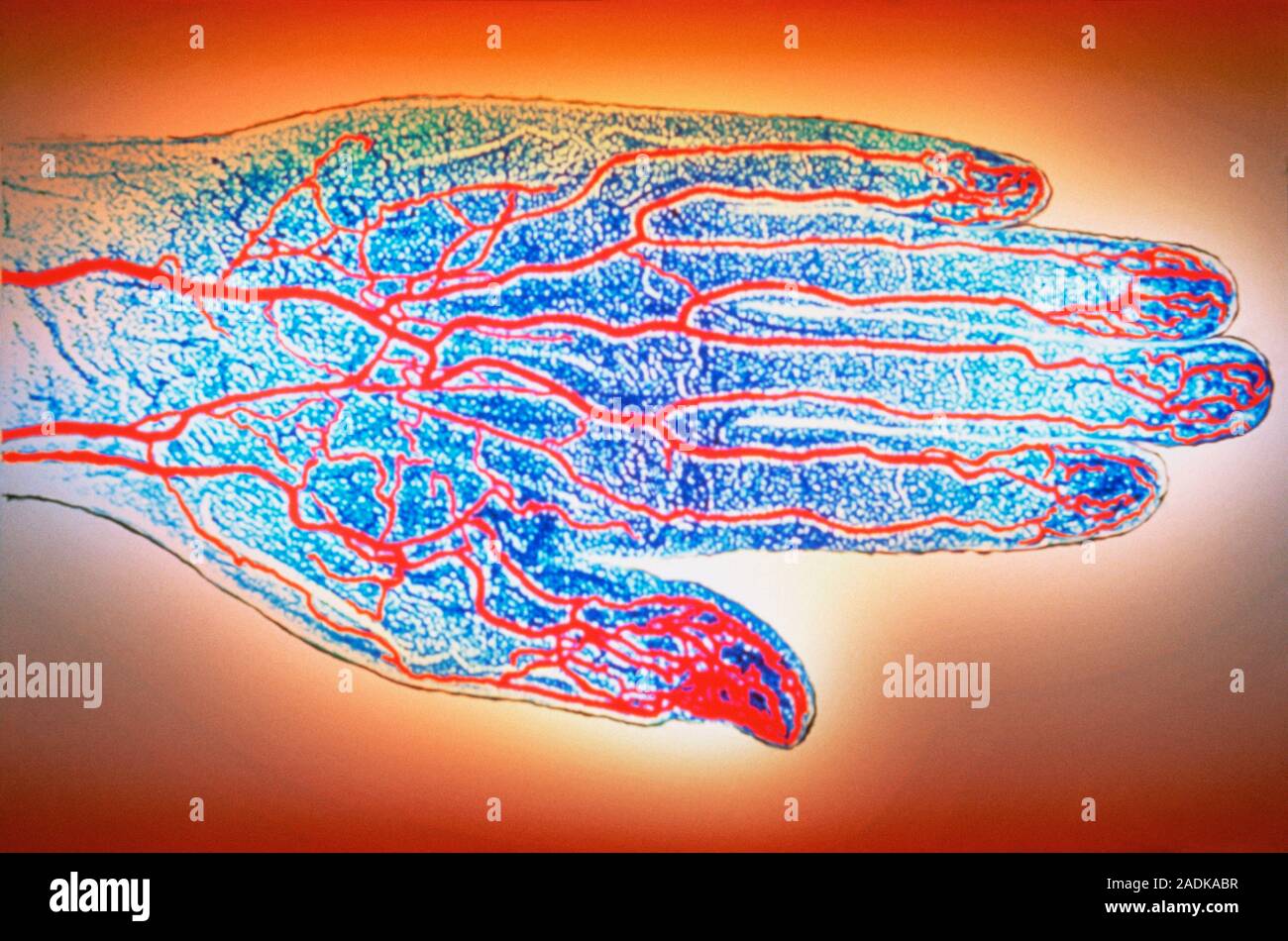 Hand Arterien. Farbige Angiogramm (X-ray) der Arterien der Hand. Die ...