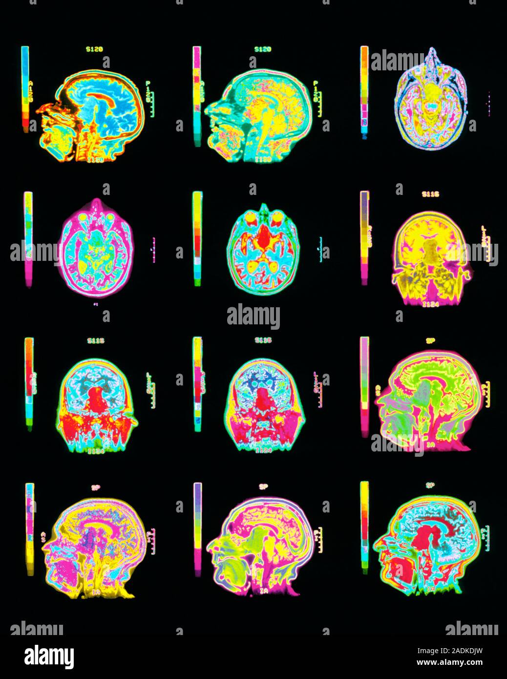 Scans des Gehirns. Farbige Magnetresonanztomographie (MRT) Scans durch einen menschlichen Kopf ...